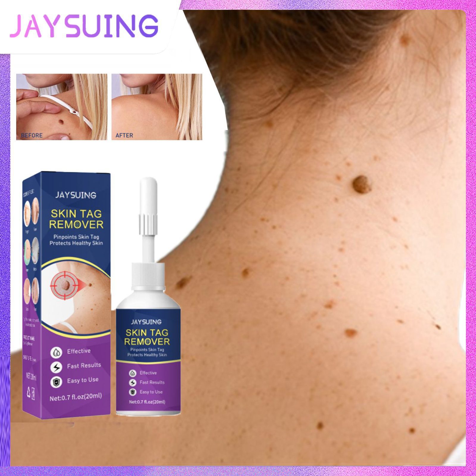 Jaysuing Wart Remover Liquid Skin Tag Removal | Jaysuing Official Website